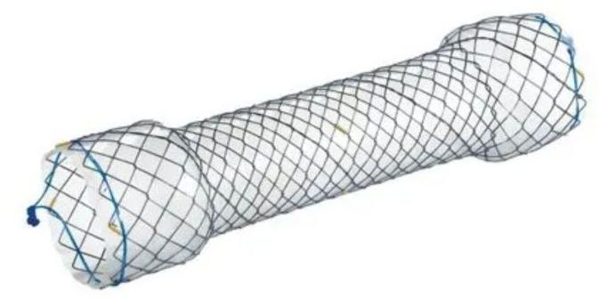 Mild steel Self Expendable Metal Stents at Rs 18,000 / piece in Chennai | Paul Medical Systems